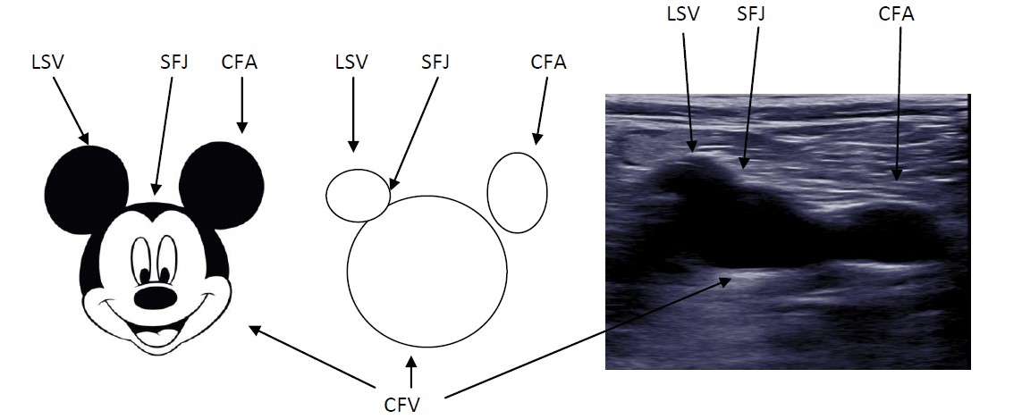 ‘Rule In’ DVT - FAMUS