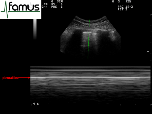 Thoracic Ultrasound Theory - FAMUS